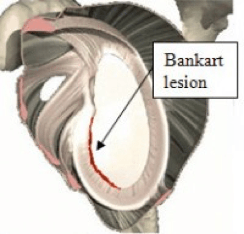 Shoulder Labrum Tears - Englewood, NJ - High Mountain Orthopedics