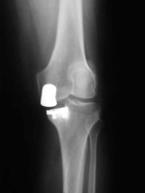 What is Unicompartmental Knee Replacement? - High Mountain Orthopedics