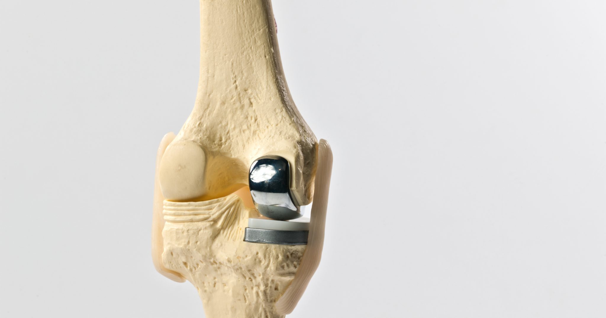 Unicompartmental Knee Replacement - Wayne, NJ - High Mountain Orthopedics